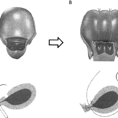 Double Vertical Compression Sutures Produced With Permission From Download Scientific Diagram