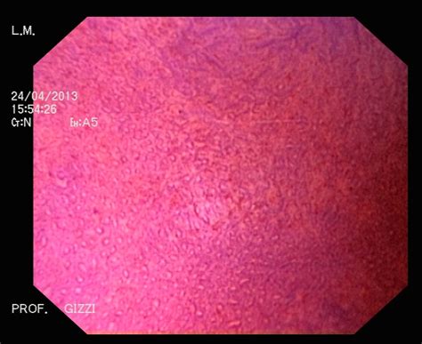 6 Lst Ng Pseudodepressed Center Colon Explorer