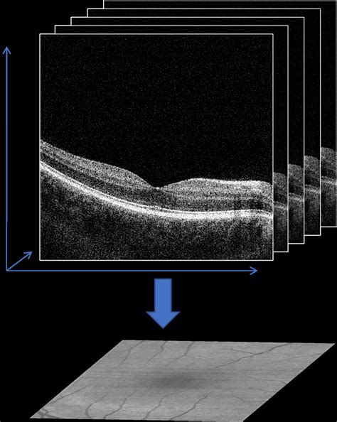 Illustration Of Simple Projection Generation From A Whole 3d Oct Scan
