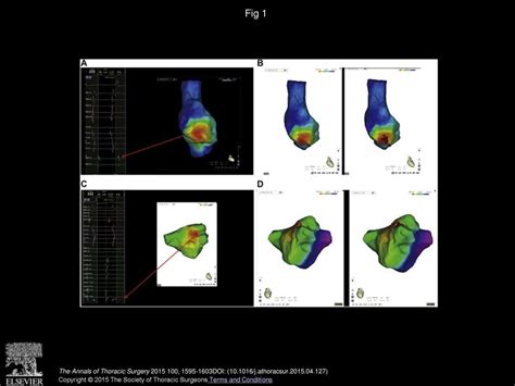 Electrophysiologic Results After Thoracoscopic Ablation For Chronic Atrial Fibrillation Babe