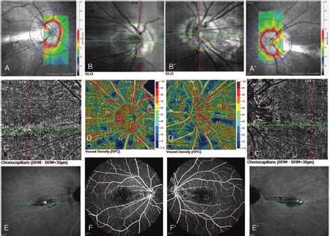 Abcd And 3abcd Oct A Revealed Bilateral Choroid Atrophy