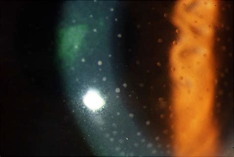 Granulomatous Keratic Precipitates