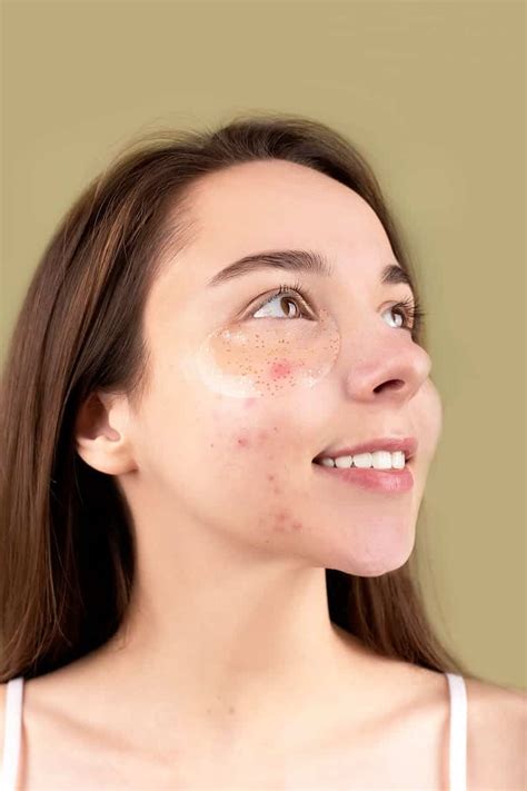 Pimple Vs Cyst Difference And Comparison