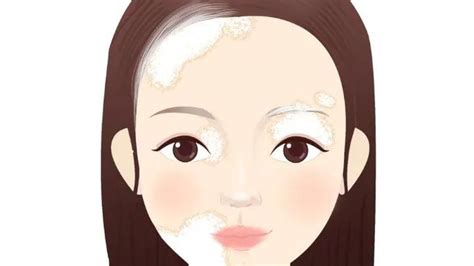 还不知道白斑是不是白癜风？9个小技巧教你辨别 知乎