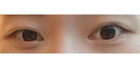 리얼후기 12 페이지 눈이 예쁘다 그래서 아몬드성형외과