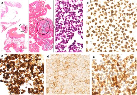 Example Of Primary Effusion Lymphoma With Expression Of T Cell Markers