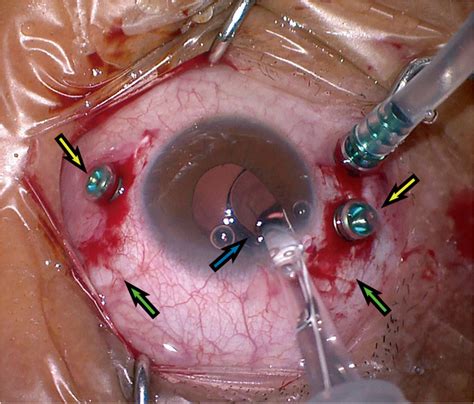 The Position Of Conjunctival Incision Green Arrow And Sclerotomy