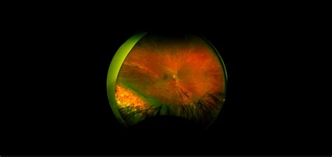 Scleral Buckle Case Study