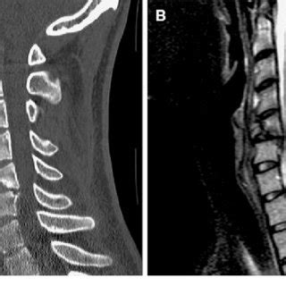Preoperative A Sagittal CT Showing The Flexion Compression Fracture Download Scientific