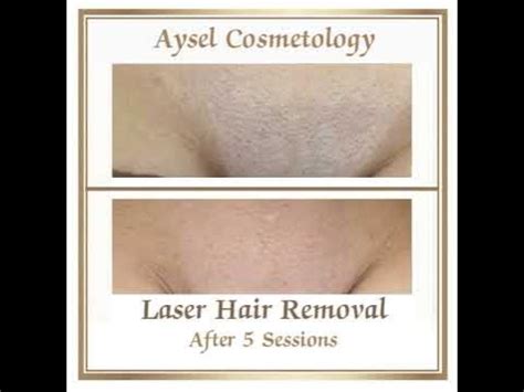 Laser Pubic Hair Removal Hair Free Care Free Youtube