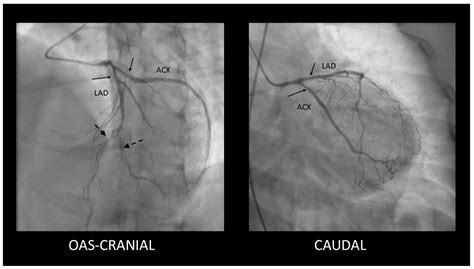 Spontaneous Coronary Artery Dissection Involving The Left Main With