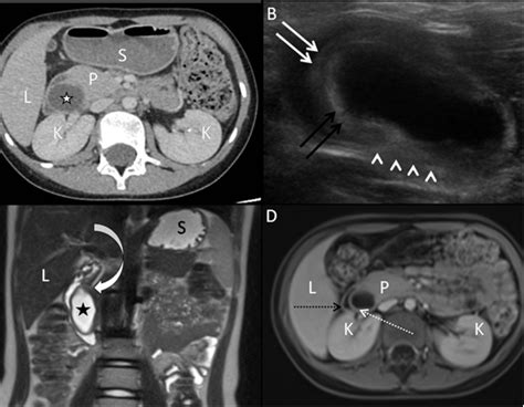 Duplication Cyst Treatment Paediatric Duplication Cyst Treatment