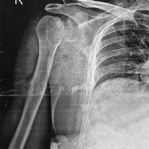 Intraoperative Images A Deltopectoral Interval And Absence Of Humeral Download Scientific