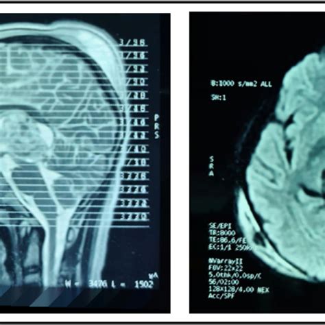 Skin Incision And Craniotomy For The Occipital Transtentorial Approach Download Scientific