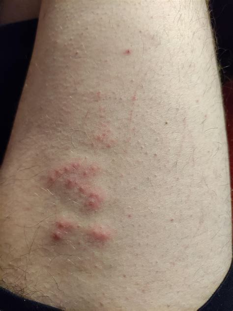 I Got These On My Upper Thigh A Few Days Ago Should I Be Concerned