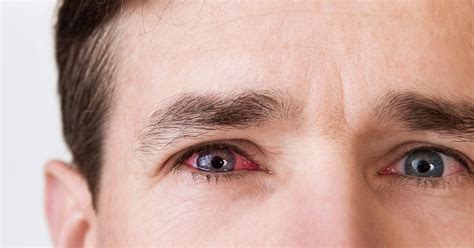 Complete Guide On Allergic Conjunctivitis
