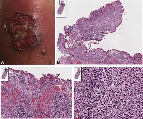 References In Neutrophilic Dermatoses Journal Of The American Academy