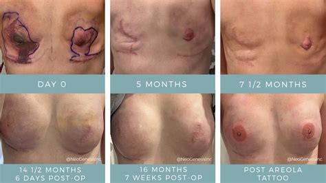 Double Mastectomy Necrosis Before And After Care Neogenesis