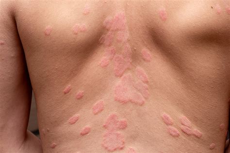 Psoriasis On Back Symptoms Triggers And Treatments