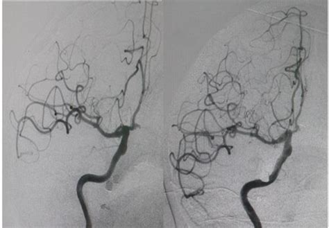 Acom Aneurysm Pre And After Coiling Download Scientific Diagram