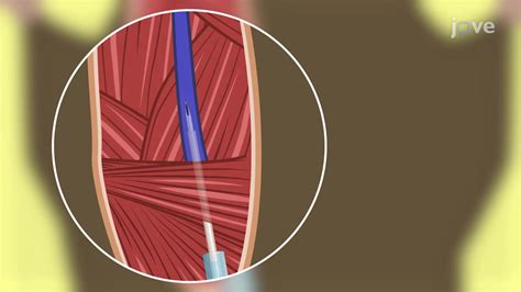 Video הזרקה תוך ורידית מבוססת צנתר של חומרים ניסיוניים טכניקה להעברת חומרים ניסיוניים תוך