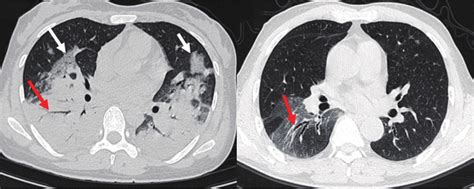 Ct Signs Of Cpp A The Fine Mesh Sign Could Be Seen In The Lesion