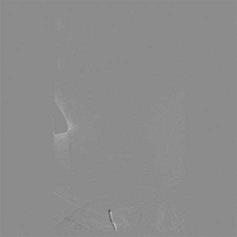 独创 零 先 循 证 而行丨联勤保障部队第九〇〇医院Fastunnel输送型球囊扩张导管在左侧大脑中动脉狭窄治疗应用体会 脑医汇