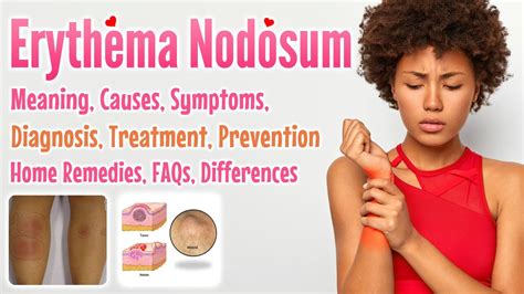 Erythema Nodosum Causes Symptoms And Treatment Health