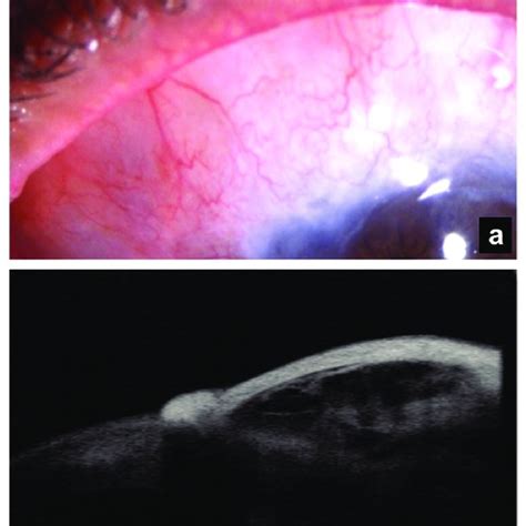 Clinical Photograph Of The Bleb Showing A A Very Thin Avascular And Download Scientific