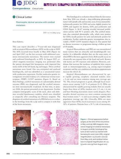 Pdf Pleomorphic Dermal Sarcoma With Cerebral Metastasis