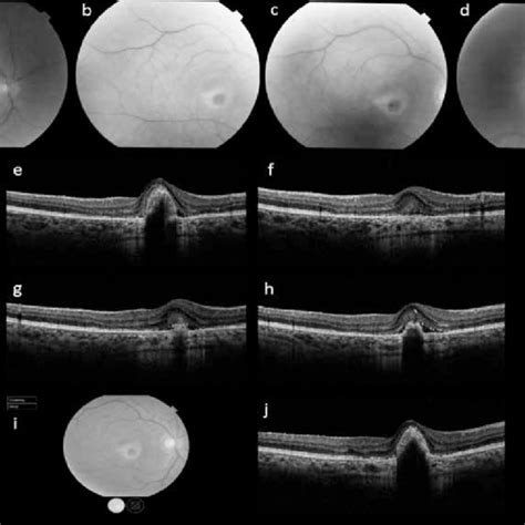 Ojo Derecho A F Granuloma Coroideo Macular Inflamación Del Nervio Download Scientific
