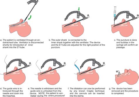 Tracheostomy Revision Cpt Code At Douglas Wilder Blog