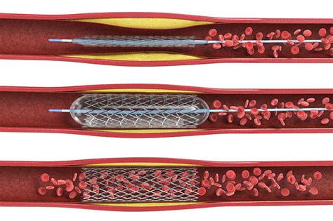 Complex Percutaneous Coronary Intervention Pci An Effective
