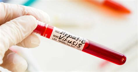 Epatite C Diagnosi Precoce Cura E Prevenzione Secondo Abbvie Sanidays