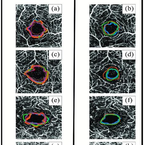 The Mean Accuracy Of Model 3 In Vascular Density Maps Of Dcp For