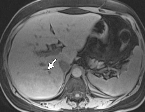 Genetics And Imaging Of Hepatocellular Adenomas 2011 Update