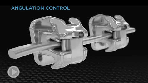 [video] Ormco On Linkedin Damon Ultima™ System Earlier Angulation Control