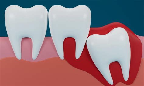7 Signs Your Wisdom Teeth Are Coming In
