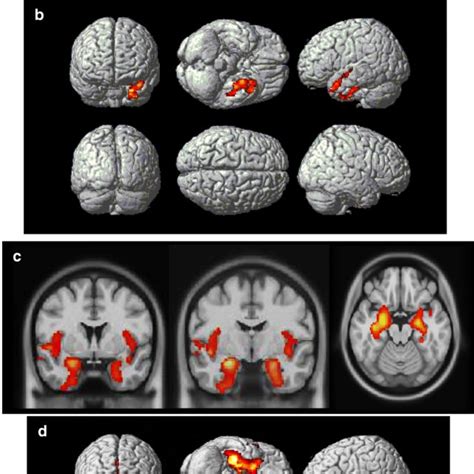 Voxel Based Morphometry Analysis Of Gray Matter Atrophy In Download Scientific Diagram