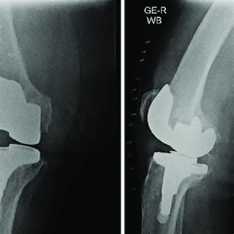 Radical Vulvectomy And Repair With Lymph Node Dissection A Anatomy Download Scientific