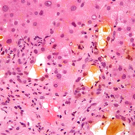 A Pregnancy With Markedly Elevated Alkaline Phosphatase