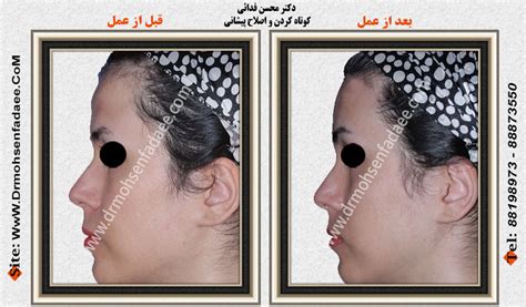 لیفت صورت فوق تخصص جراحی پلاستیک دکتر محسن فدایی