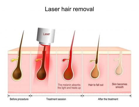 Can Laser Hair Removal Help With Pilonidal Disease What Patients