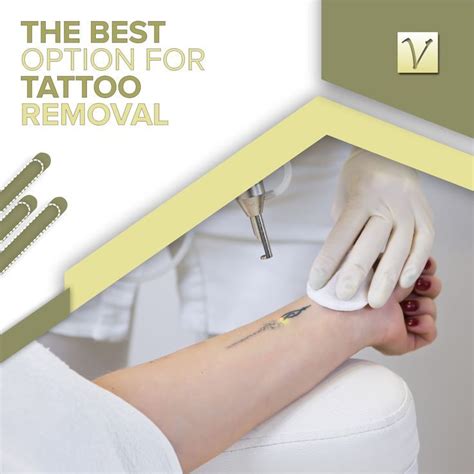 Laser Tattoo Removal Is The Gold Standard” Of Tattoo Removal Options