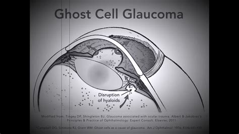 Pablo Andrés Grigera On Linkedin Glaucoma