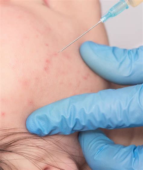 Kenalog Scalp Injections By Skin Deep Midtown Med Spa