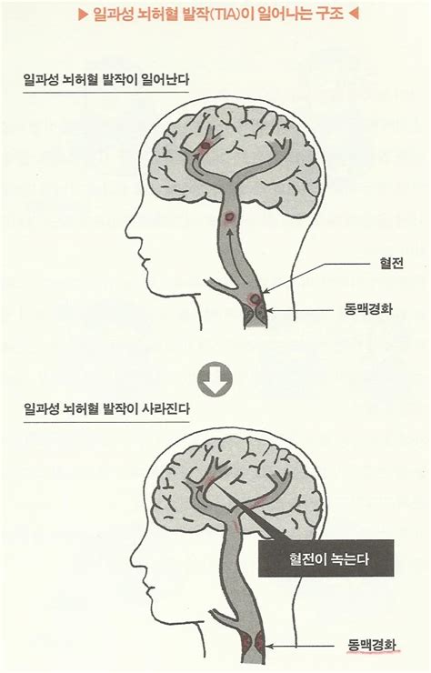 커뮤니티 전문가 코너 뇌졸중 2 뇌출혈과 뇌경색