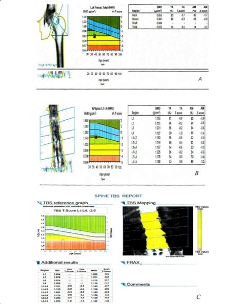 A Single Patient Record Of Dexa Scan A The Decreased Bmd At Hip B Download Scientific Diagram