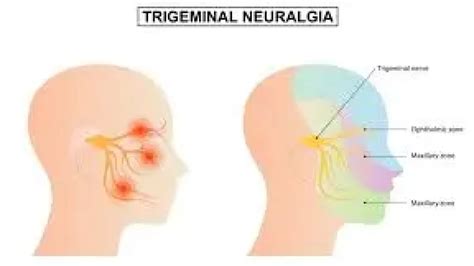 Fifth Cranial Nervetrigeminal Samarpan Physiotherapy