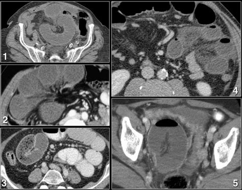 The Radiology Assistant Closed Loop Obstruction With Video